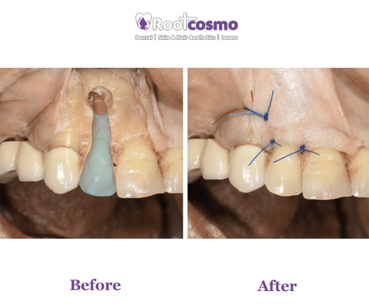 Dental Care - Before After - RootCosmo