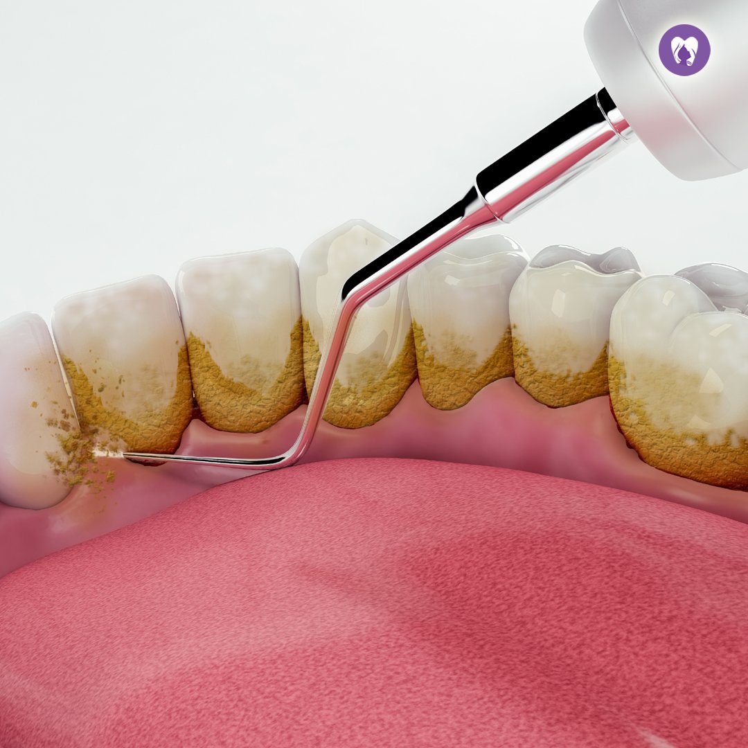 Rediscover Your Bright Smile with Dental Cleanings|RootCosmo