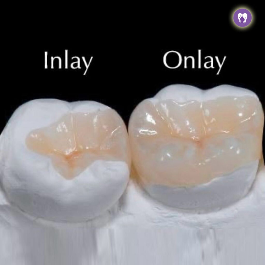 Renew Your Smile with Dental Inlays and Onlays - RootCosmo
