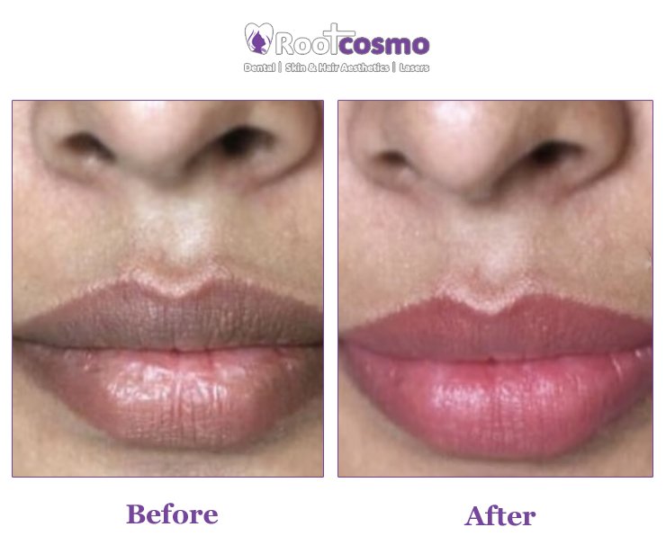 Lip Pigmentation Treatment: Unlock Your Beautiful Smile