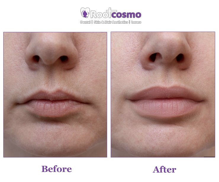 Revive Your Confidence with Lip Rejuvenation at RootCosmo