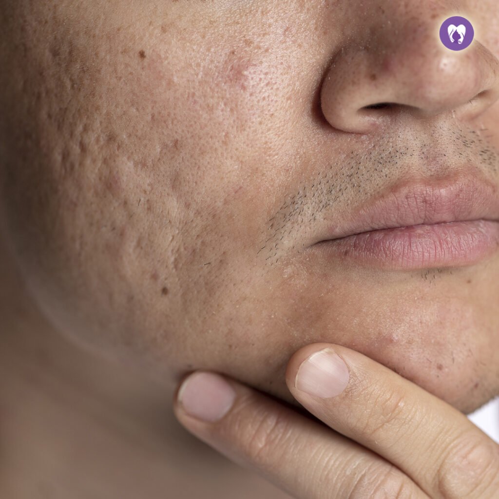 Open Pores Treatment: Unlock Radiant Skin with Aesthetic Cosmetology