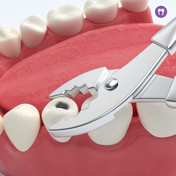 Tooth Removal (Extraction) Treatment at RootCosmo