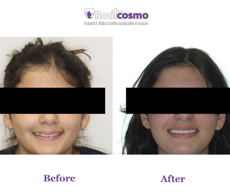 Achieve Your Perfect Smile with Invisible Braces (Invisalign) Treatment