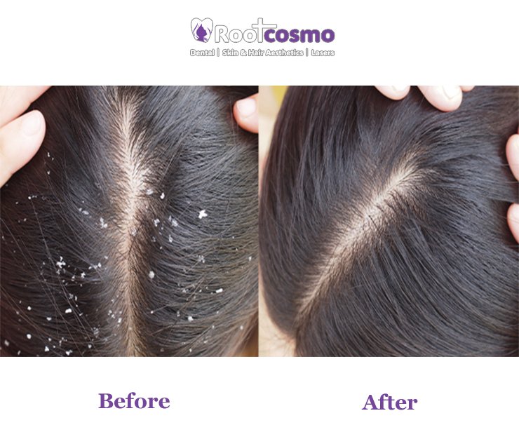 Say Goodbye to Dandruff with Aesthetic Cosmetology at RootCosmo