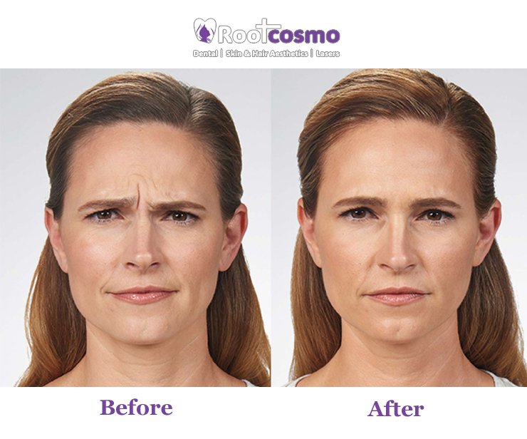 Rediscover Youthful Radiance with Botox (Botulinum Toxin) Injections at ...