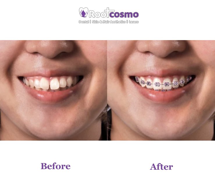 Orthodontic (Braces or Aligners) Treatment at RootCosmo: A Perfect ...