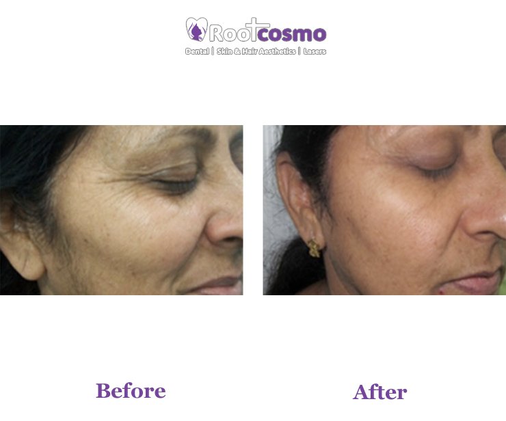 Facial Rejuvenation with Aesthetic Cosmetology by Dr. Neethu Nanda