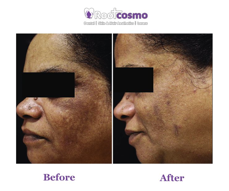 Unlock Your Skin's Potential with Growth Factor Concentration (GFC) at ...