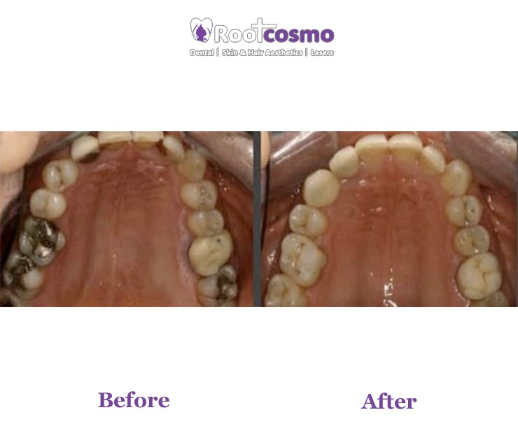 Renew Your Smile with Dental Inlays and Onlays - RootCosmo