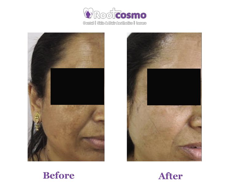 Melasma Treatment at RootCosmo: Unveil Radiant Skin