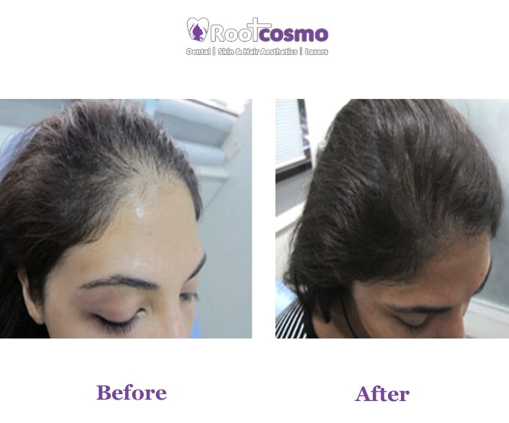 Mesotherapy for Hair: Rediscover Your Luscious Locks with Expert Care
