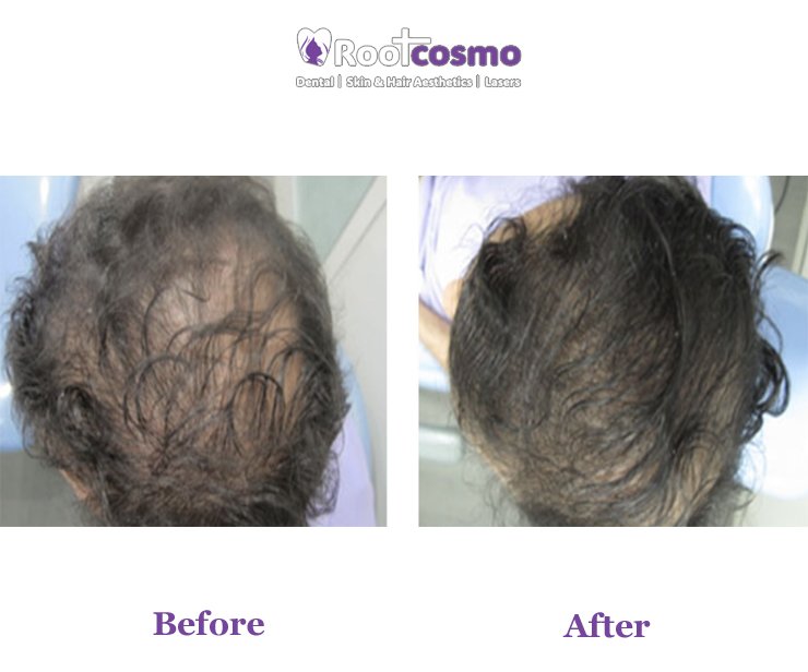 Mesotherapy for Hair: Rediscover Your Luscious Locks with Expert Care