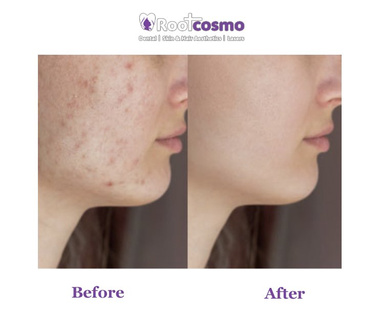 Microneedling (MNRF) Treatment at RootCosmo Cosmetology Clinic