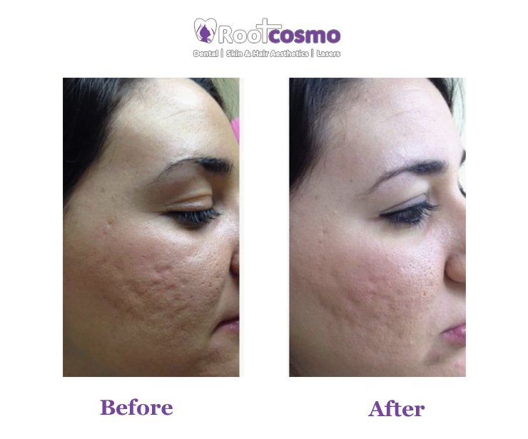 Microneedling (MNRF) Treatment at RootCosmo Cosmetology Clinic