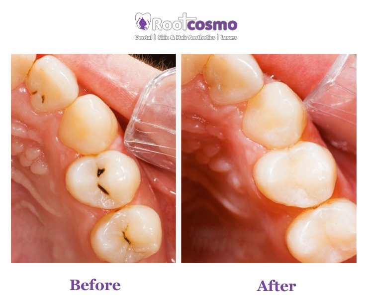 Protect Your Smile with Dental Sealants at RootCosmo