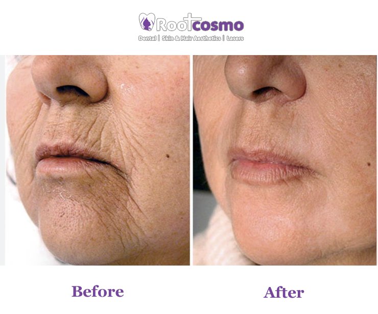 Achieve Youthful Radiance with Skin Tightening at RootCosmo Cosmetology ...