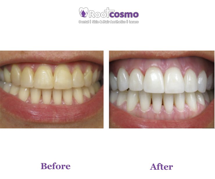 Discover Your Brightest Smile with Teeth Whitening (Bleaching) Treatment