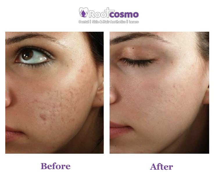 Discover Radiant Skin with Vampire Facial at RootCosmo